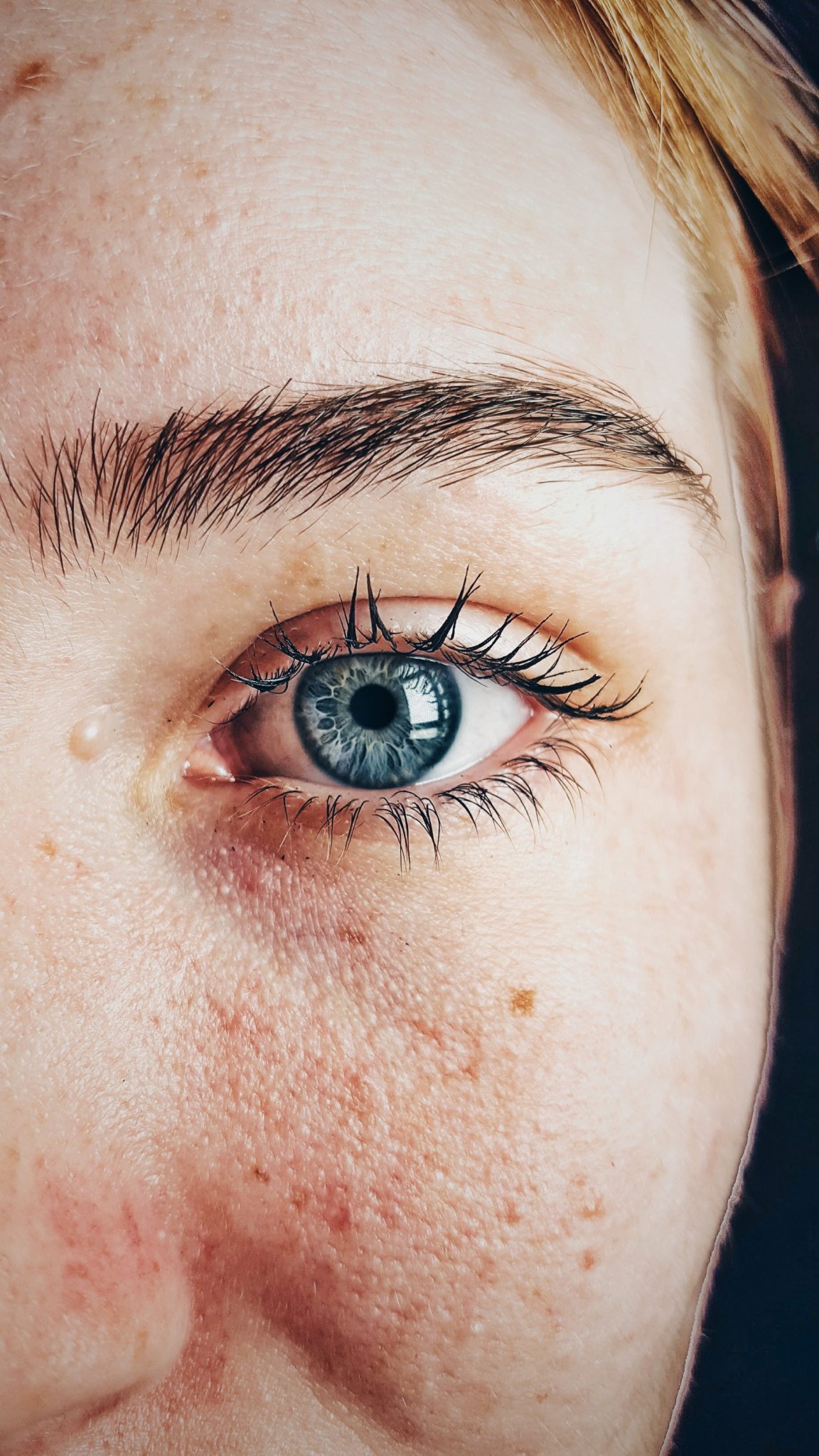 Eyelash + eyebrow loss and your thyroid | Lisa Costa-Bir